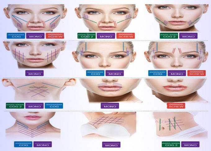 Aesthetics PDO PCL PLLA Threads 100mm 120mm Face Threading Face Lift