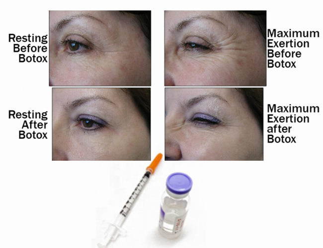 Innotox Botulinum Toxin Injections Botox Powder 100iu / Vial
